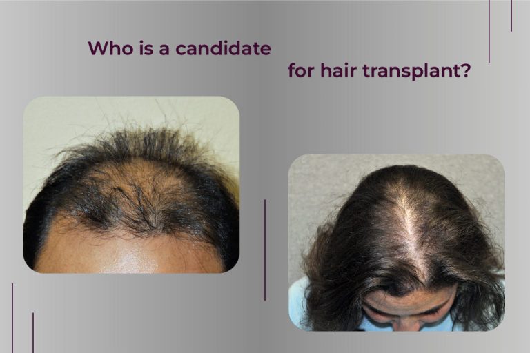 Who is a candidate for a hair transplant? | Toronto Clinic
